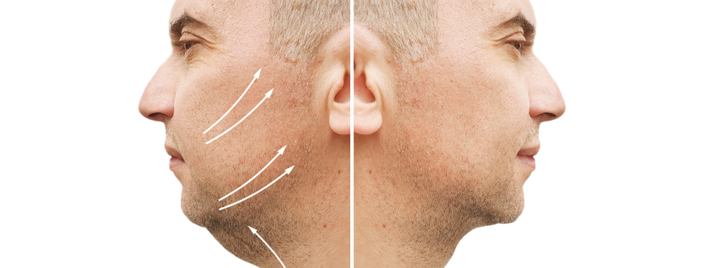 Facelift Considerations for Men – Tailored Aesthetic Solutions